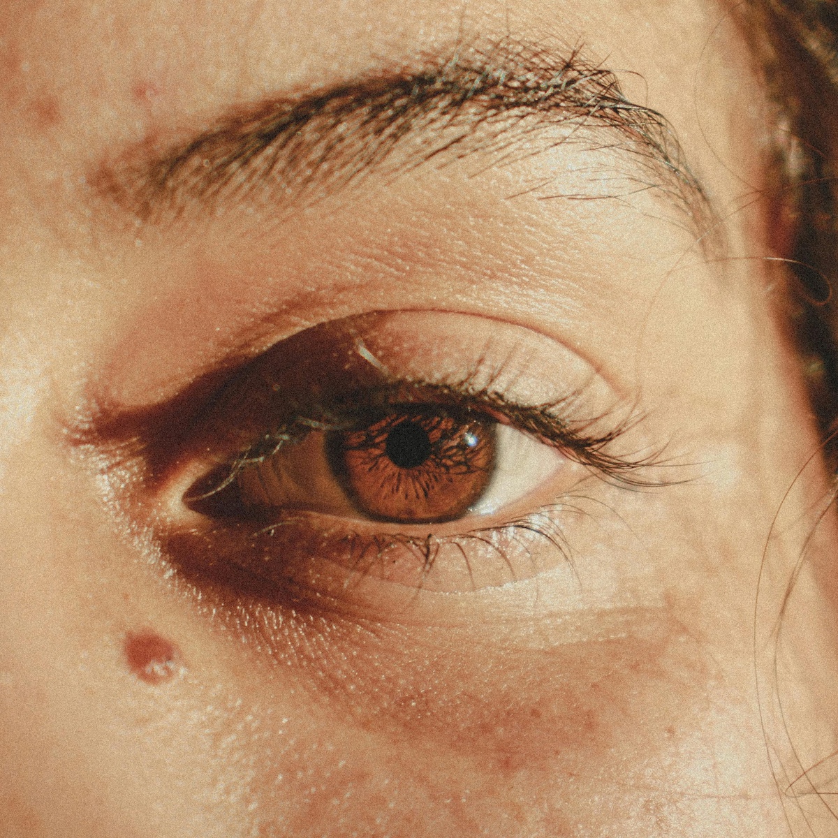 What You Should Know About Mole Removal | The Inspiration Edit